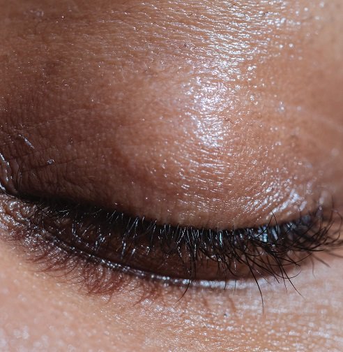 Herpès de l'œil ou Herpès Occulaire : Comment le soigner